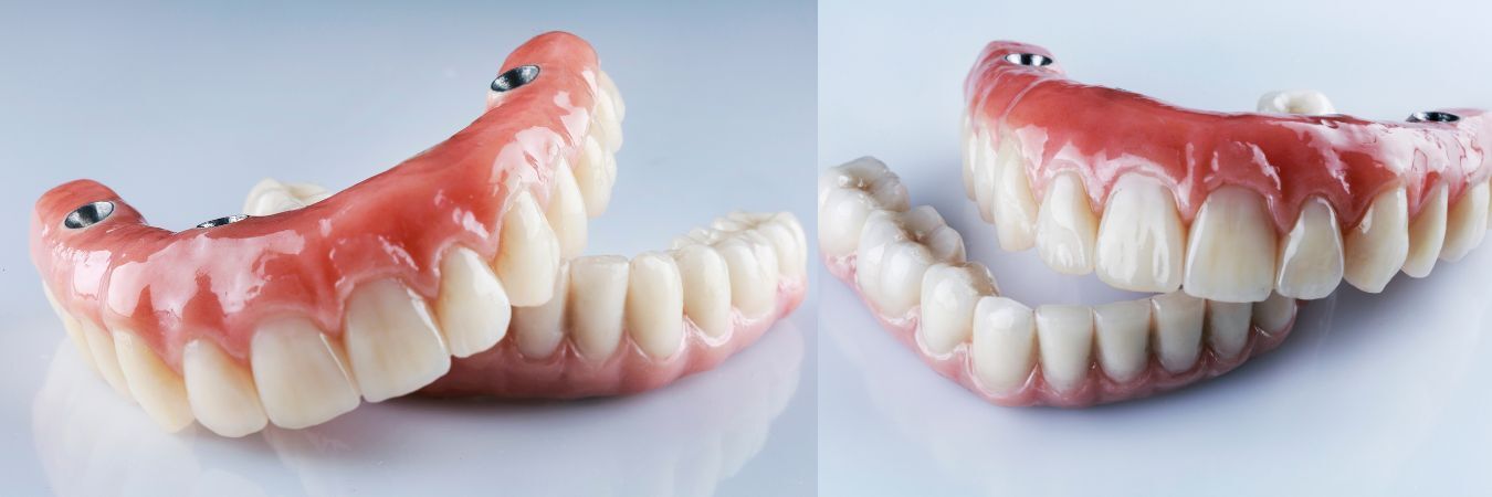 Full Arch Zirconia Implants Prosthesis: A Step-by-Step Guide